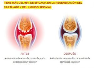 Como curar la artrosis de rodilla